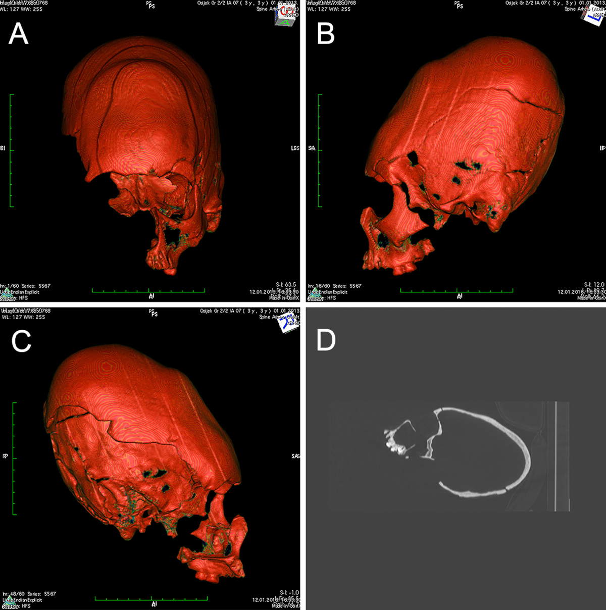 Medieval Croatian skulls indicate that people intentionally modified ...